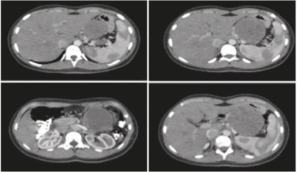 Pancreatectomía distal laparoscópica con preservación del bazo para el ...