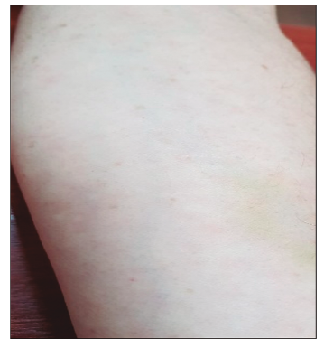 Syphilitic hepatitis: should it be added to the algorithm of hepatogram ...