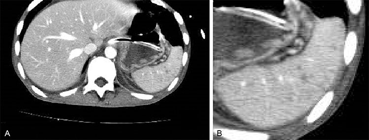 Manifestaciones tomográficas extrapulmonares de TBC y algunas de sus ...