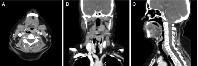 Transoral robotic supraglottic partial laryngectomy: report of the ...