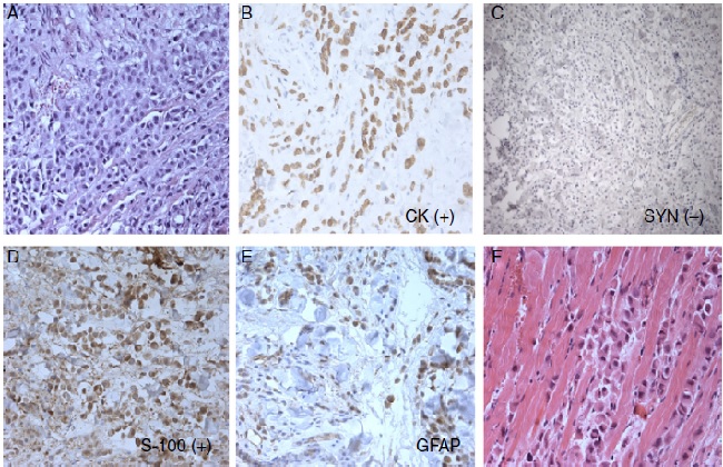 Bilateral primary histiocytoid eccrine sweat gland carcinoma of eyelids☆