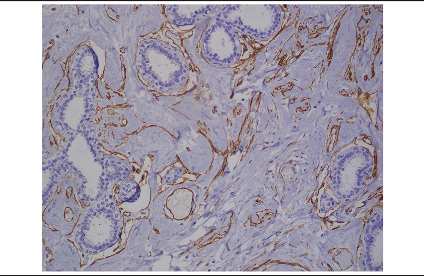 Giant nodular pseudoangiomatous stromal hyperplasia of the breast with ...