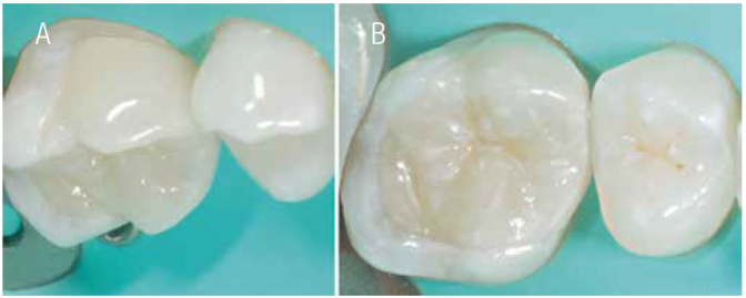 Rehabilitating Form, Function and Natural Aesthetics with Onlay Ceramic ...