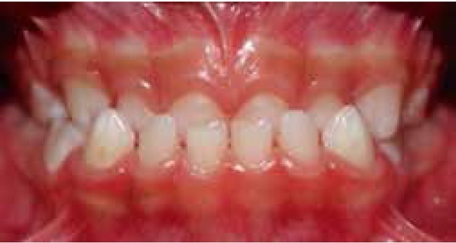 Quick correction of a skeletal class III maloclussion in primary ...