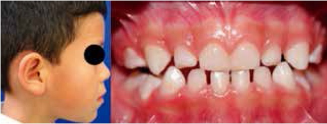 Quick correction of a skeletal class III maloclussion in primary ...