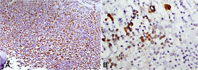 Fatal familial hemophagocytic lymphohistiocytosis with perforin gene ...