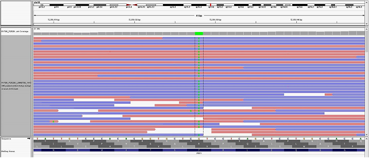 Fatal familial hemophagocytic lymphohistiocytosis with perforin gene ...
