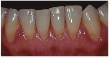 Use of dermal matrices to change gingival phenotypes