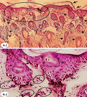 Clinical and histopathological study of the phototoxic dermatitis in ...