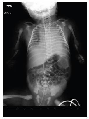 Síndrome de Townes-Brocks en Barranquilla, Colombia: Reporte de caso y ...