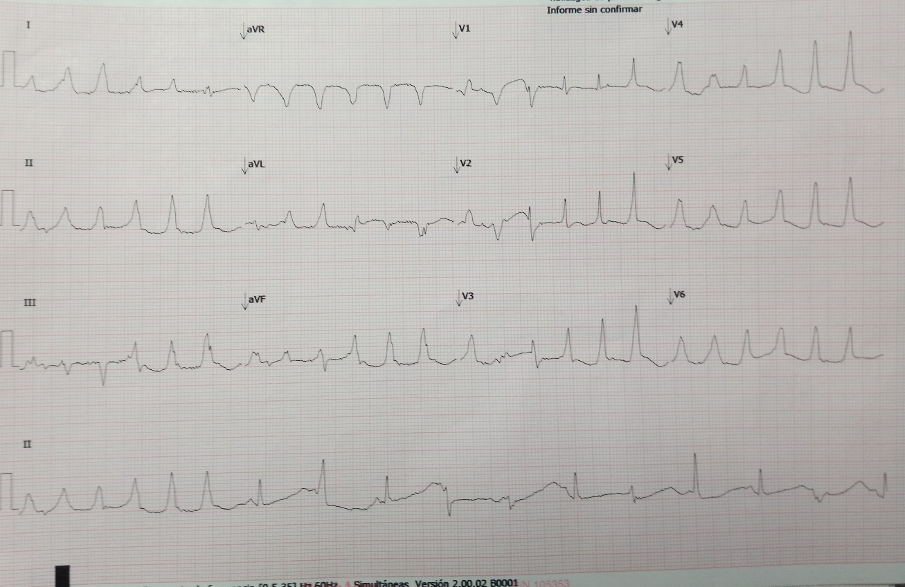 Manifestaciones tóxicas cardiovasculares con el uso de antimoniales en ...