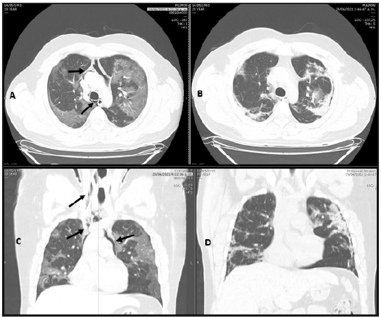 SARS-CoV-2 pneumomediastinum. A proposed pneumomediastinum classification