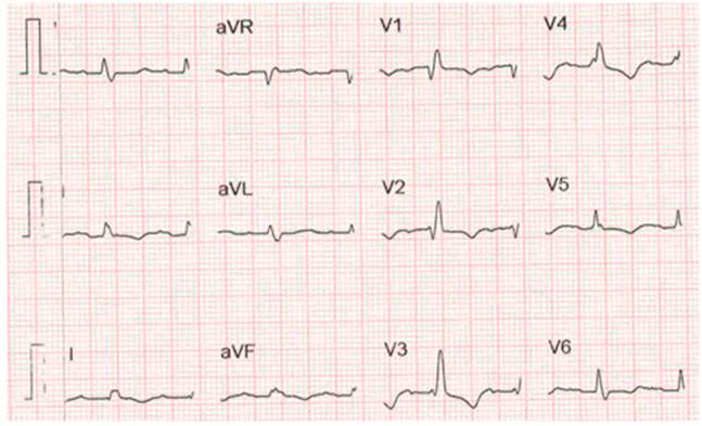 Angiosarcoma cardíaco: una causa rara de insuficiencia cardíaca
