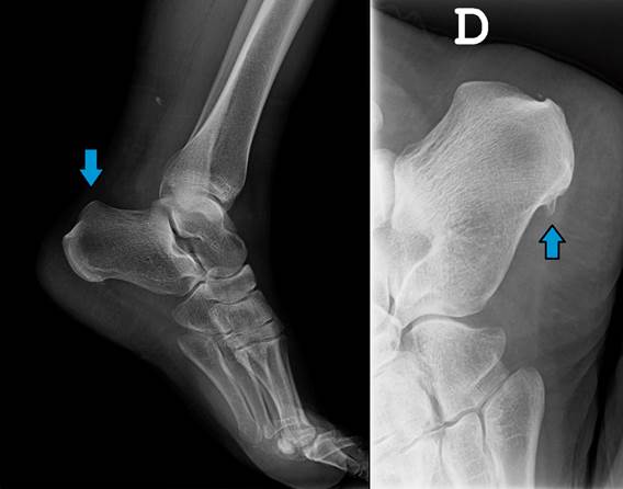 Síndrome de Haglund: «¿Qué tengo en el talón?»