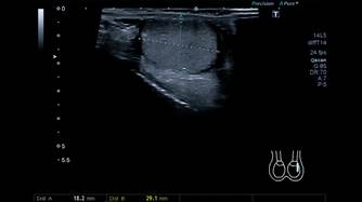 Transiluminación negativa en patología testicular