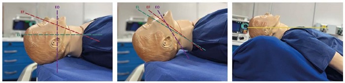 Rapid Sequence Induction and Intubation: A Narrative Review