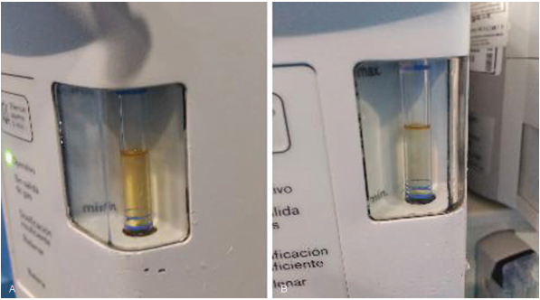Desflurane yellowing