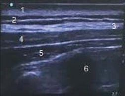 Erector spinae plane (ESP) block for postoperative analgesia in total ...