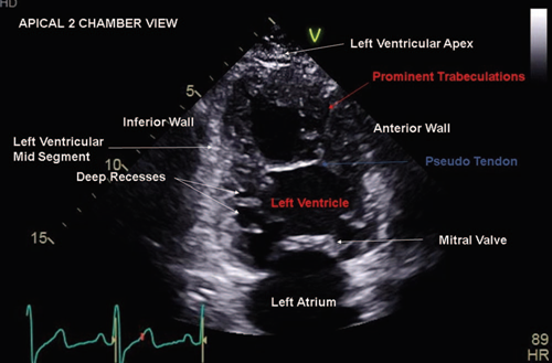 Isolated left ventricular non compaction cardiomyopathy in pregnancy