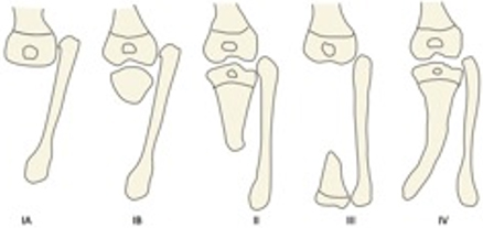 Hemimelia del peroné y la tibia, más que un hueso ausente: presentación ...
