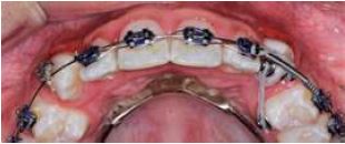 Multidisciplinary Management of Buccally Retained Maxillary Canine with ...