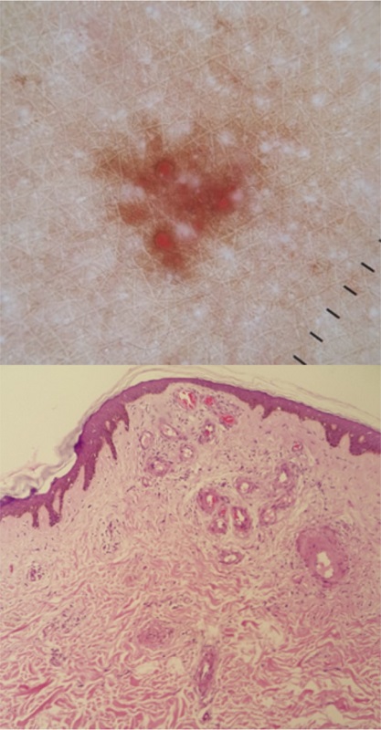 Acurácia da teledermatoscopia móvel na avaliação de lesões cutâneas ...