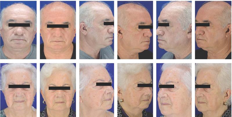Peeling de ATA localizado para rugas estáticas da face: série de casos