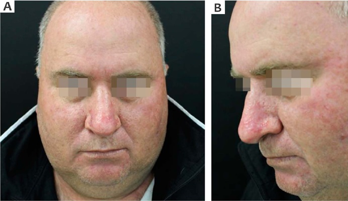 Eletrocirurgia em rinofima: relato de dois casos