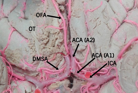 Morphological evaluation of the distal medial striate artery. A study ...