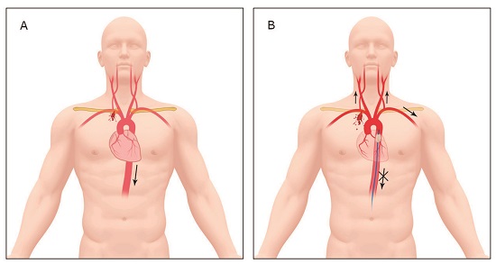 Damage control surgery for thoracic outlet vascular injuries: the new ...