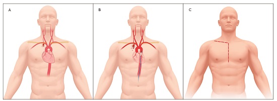 Damage control surgery for thoracic outlet vascular injuries: the new ...