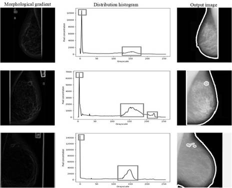 An approach to edge detection in medical imaging through histogram ...
