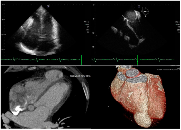 Pericarditis constrictiva con dilatación aneurismática apical del ...