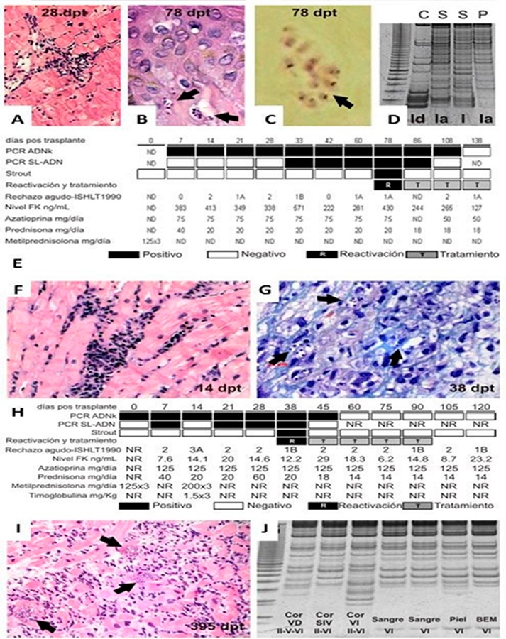 Trasplante cardíaco en miocardiopatía chagásica: 23 años de experiencia ...