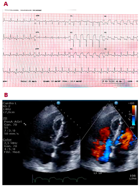 Rotura del septum interventricular por infarto agudo de miocardio ...