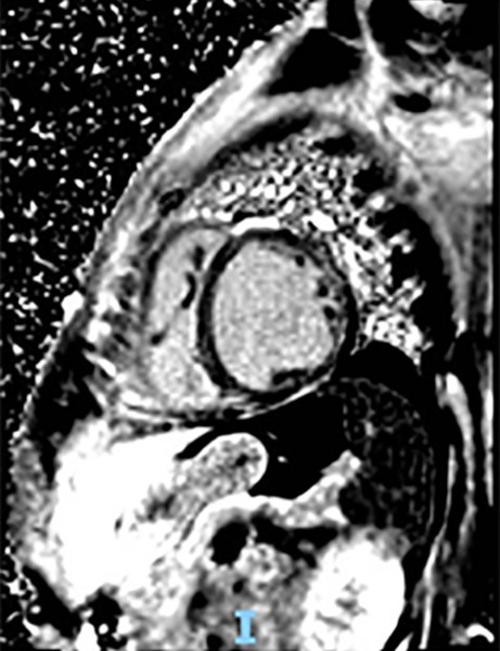 Miocardiopatía dilatada y distrofia muscular de Duchenne