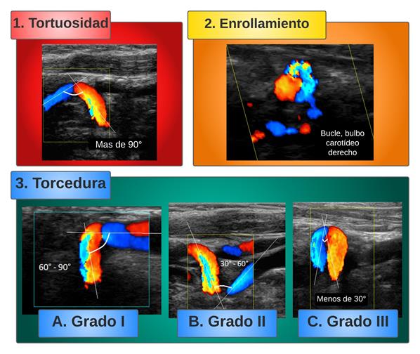 Dolicoarteriopatías carotídeas: un enfoque global
