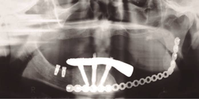 Rehabilitation using immediate loading in patients with partial ...