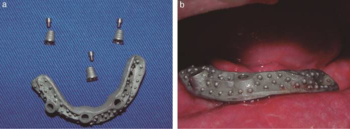 Rehabilitation using immediate loading in patients with partial ...