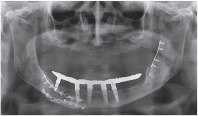 Rehabilitation with implants simultaneously to mandible fracture ...