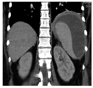 Uso del sistema over-the-scope clip (OTSC) en el tracto ...