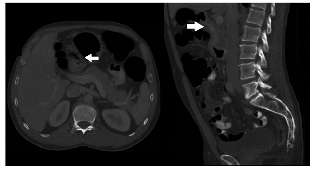 Absceso de pared duodenal secundario a palillo de dientes enclavado en ...