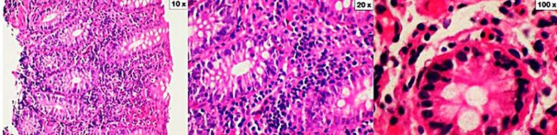 Colitis microscópica, serie de casos y revisión de la literatura