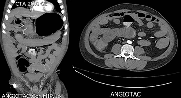 A Rare Complication of Gastrointestinal Bleeding: Jejunal ...