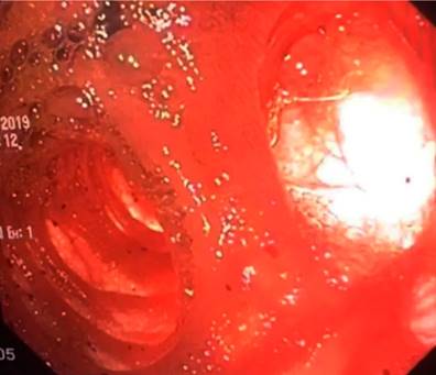 Massive Gastrointestinal Bleeding Caused by Multiple Small Intestinal ...