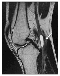 Enfermedad quística de la adventicia, arteria poplítea