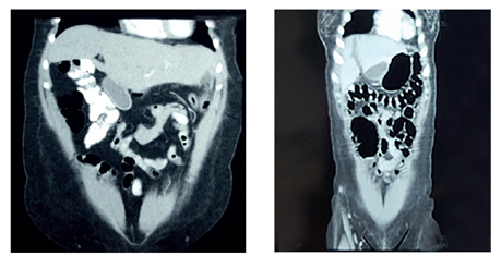 Vólvulo de la vesícula biliar