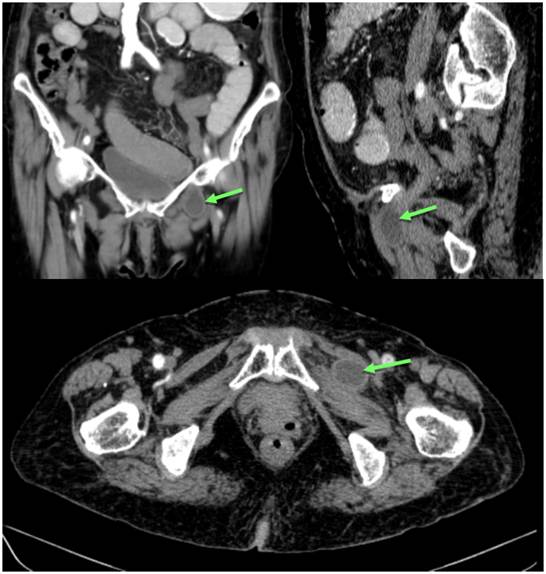 Hernia obturatriz: Aspectos clínicos, imagenológicos y tratamiento