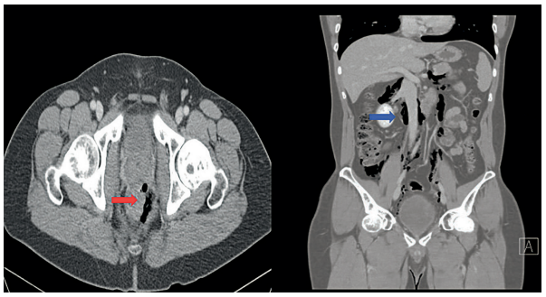 Lesiones Anales Por Violación