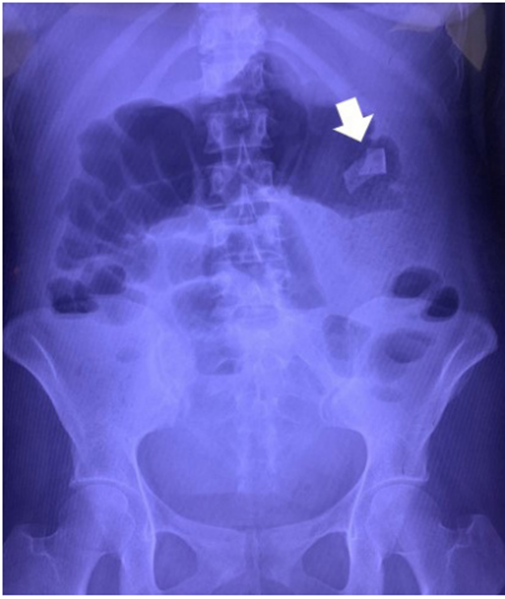 Migración completa de textiloma simulando tumor de colon